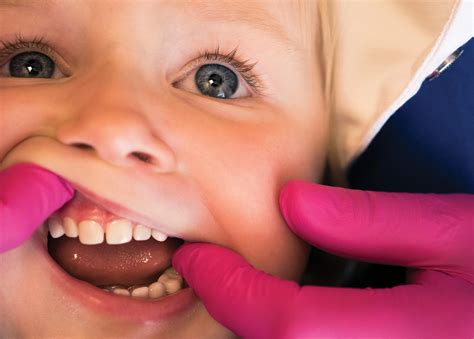 Osteogenesis Imperfecta Teeth