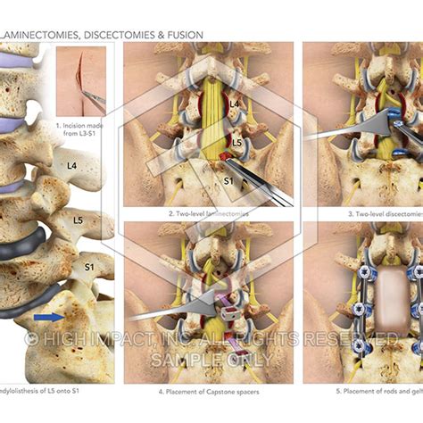 Discectomy And Laminectomy