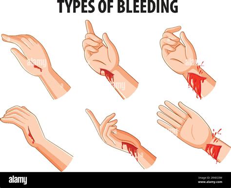 Vector Cartoon Illustration Comparing Various Types Of Bleeding On