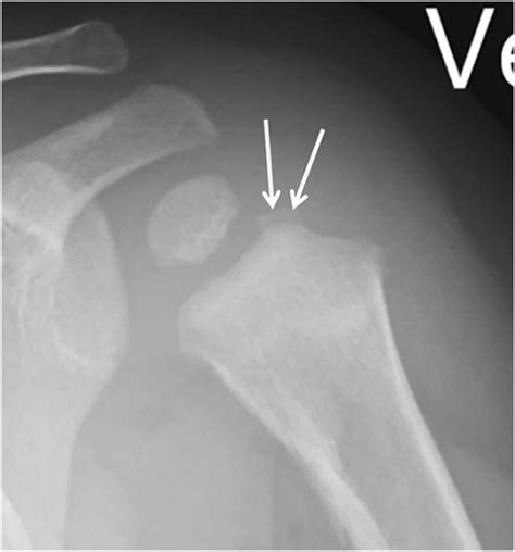 Anteroposterior Radiograph Of The Proximal Left Humerus In An