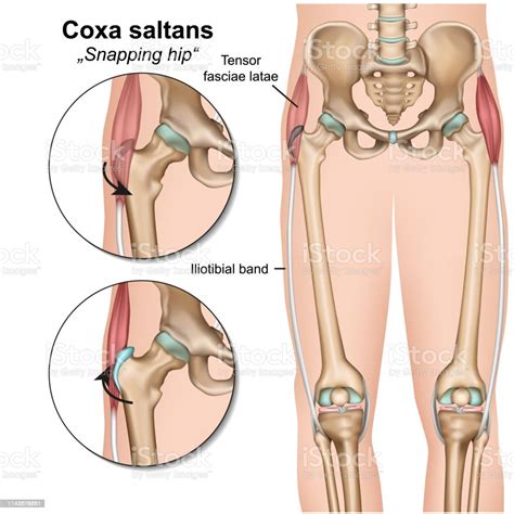 Coxa 살 탄 증후군 3d 의료 벡터 일러스트 레이 션에 흰색 배경 엉덩관절에 대한 스톡 벡터 아트 및 기타 이미지 엉덩