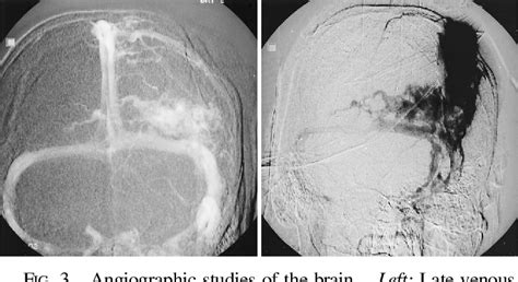 Sinus Pericranii Semantic Scholar