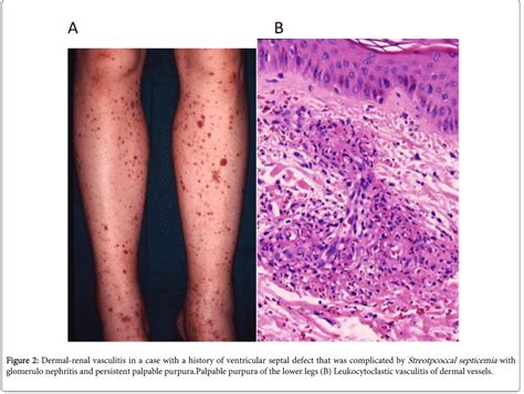 Importance Of Cutaneous Vasculitis In Rheumatology