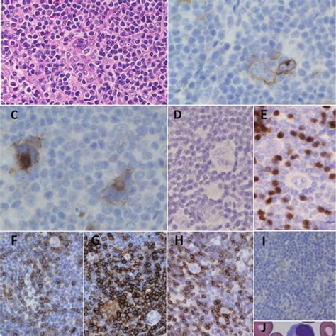 Right Inguinal Lymph Node Biopsy Hematoxylin Eosin Staining Showed
