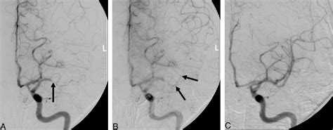 Figure 1 From Intra Arterial Thrombolysis Site As A Favorable Indicator For Cerebrovascular