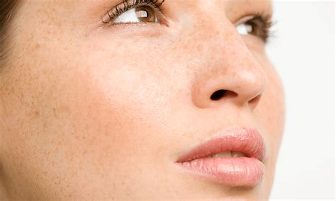 Reduce Signs Of Ageing By Eliminating Mid Cheek Lines The Harley Street Filler Specialist