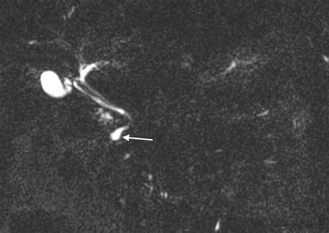 Choledochal Cyst And Anomalous Pancreaticobiliary Junction Radiology