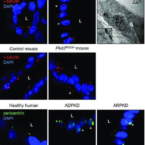 Centrosomal Abnormalities In Cystic Cholangiocytes A Representative