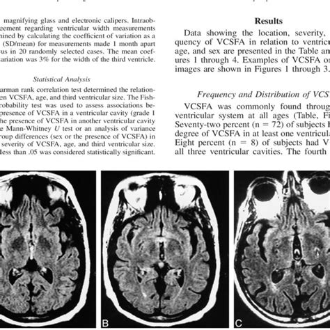 Pdf Intraventricular Csf Pulsation Artifact On Fast Fluid Attenuated