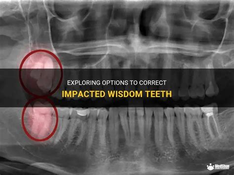 Exploring Options To Correct Impacted Wisdom Teeth Medshun