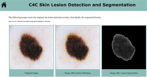 Github Mdshafiquskin Lesion Detection
