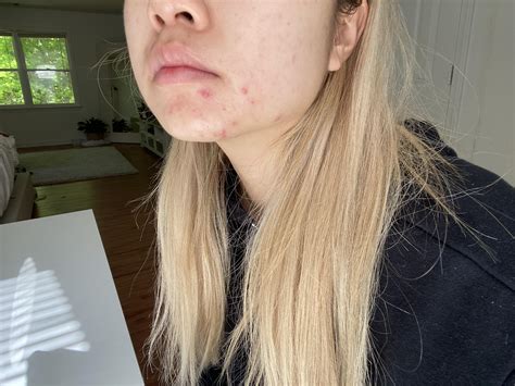 Hormonal Cysticnodular Acne On Chin Only What Works Im Desperate