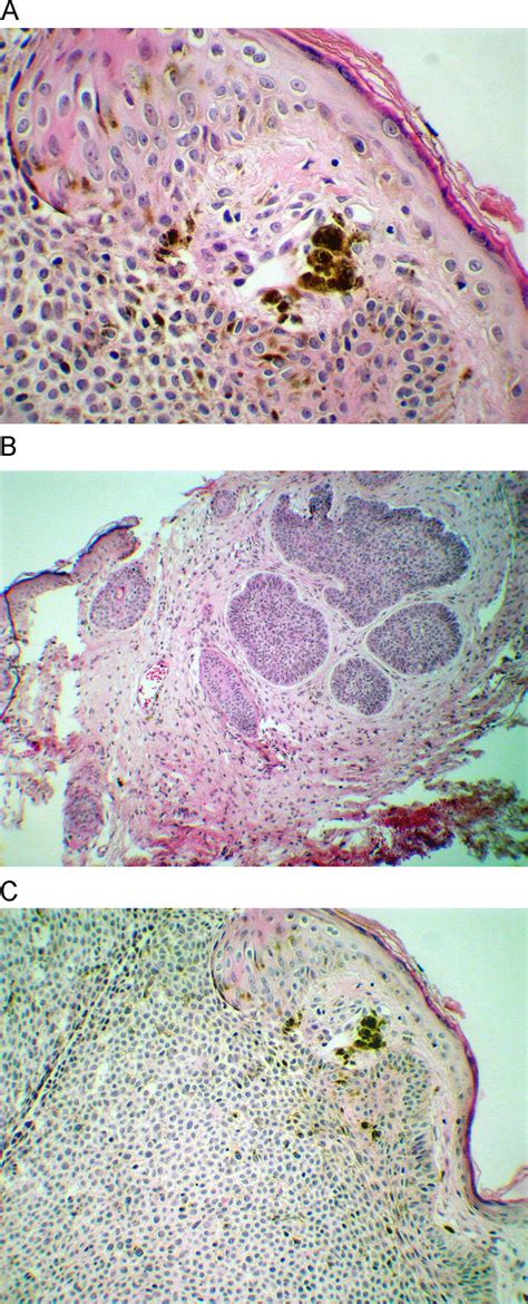 Superficial Basal Cell Carcinoma Histology