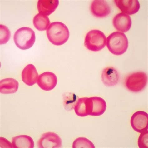 Plasmodium Falciparum Slide Smear Carolina Biological Supply