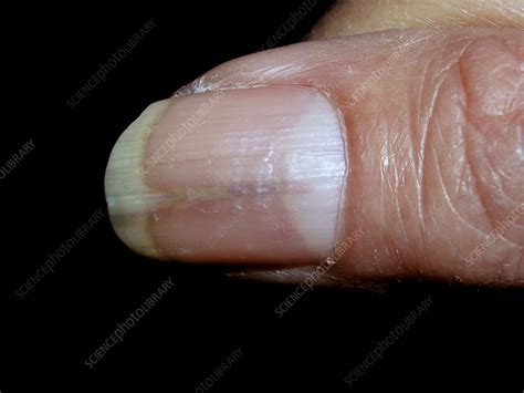 Median Nail Dystrophy Stock Image C056 4874 Science Photo Library