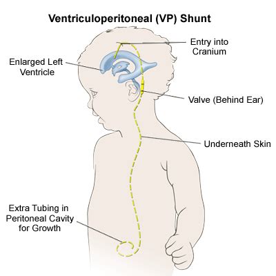 The Project BENG 492 Group 2 Ventriculoperitoneal Shunts