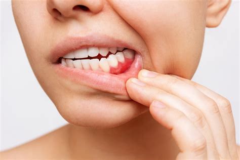 Understanding Gum Disease Symptoms And When To Seek Help