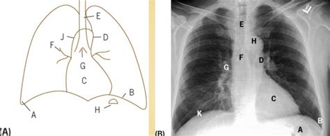 Chest Xray Diagram Quizlet