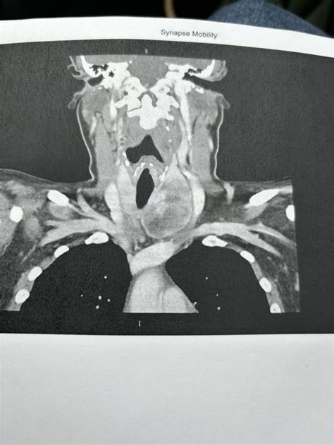 5cm Nodule R Thyroid