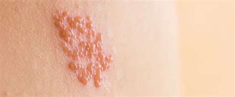 Juosiančioji Pūslelinė Atsiradimo Priežastys Pasireiškimas Ir Gydymo