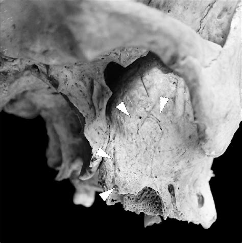 Right Posterior Maxilla There Is Generalised Abnormal Porosity And