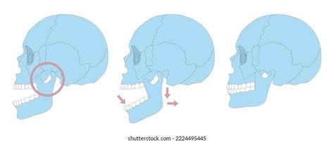 Mandible Bone Anatomy And Labeled Diagram Getbodysmart