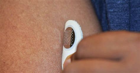 New Microneedle Patch Therapy For Food Allergies Takes Step Forward
