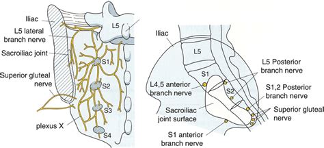 Complications Of Sacroiliac Joint Block And Ablation Anesthesia Key