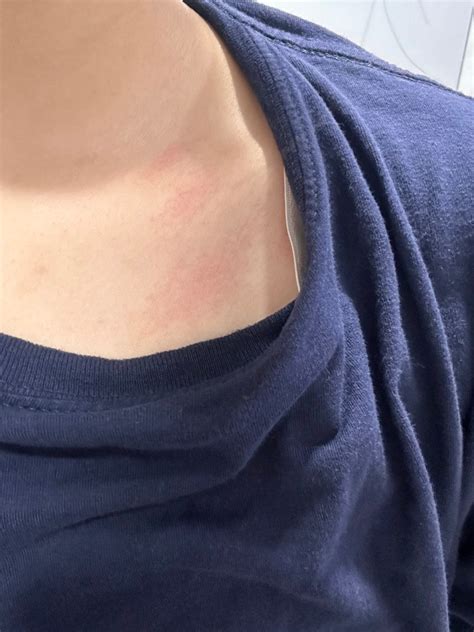 샤워 후 피부가 자꾸 붉어져요 지식in