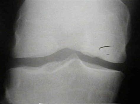 Osteochondroma Osteocartilaginous Exostosis Wheeless Textbook Of