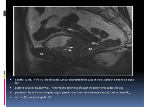 Ppt Bladder Ca Staging Powerpoint Presentation Free Download Id