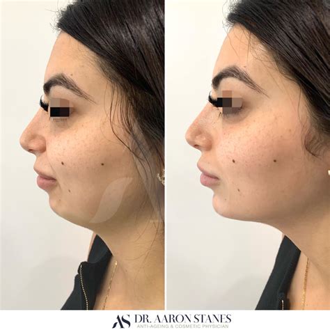 A Non Surgical Chin Augmentation Can Reshape Your Chin Using Dermal