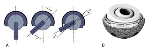 Comparison Of Constrained Acetabular Components And Dual Mobility Cups In Revision Total Hip