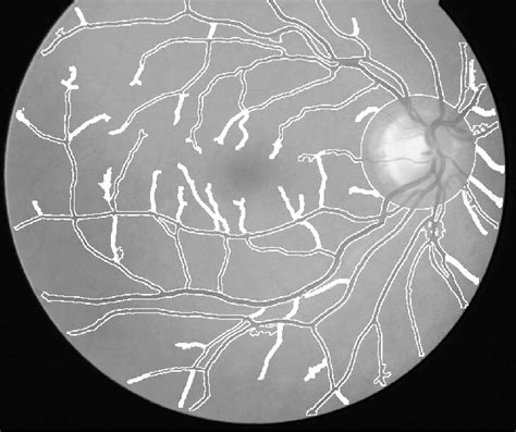 Figure 1 From Retinal Vessel Tree Segmentation Using A Deformable Contour Model Semantic Scholar
