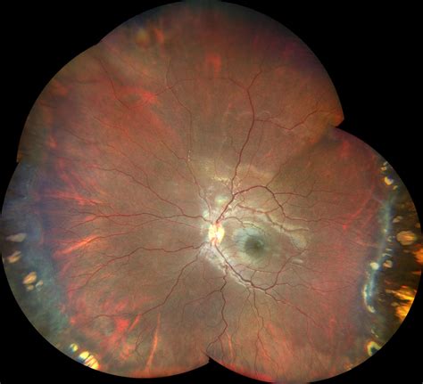 Retina Conditions Explained Retinopathy Of Prematurity Rop
