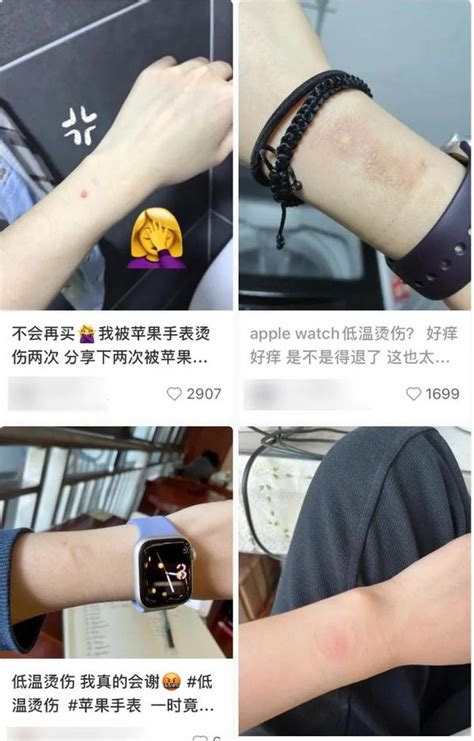 戴苹果手表，多人手腕变形？还出现疼痛症状！苹果官方回应 知乎