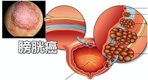 Are Bladder Tumors Benignbladder Cancer Is Bladder Cancer Inews