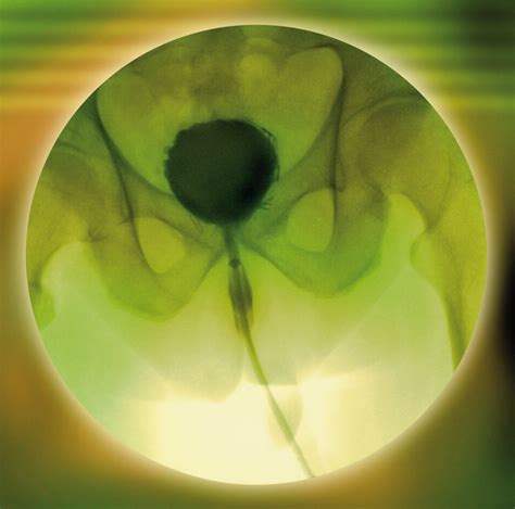 Later Line Treatments For Metastatic Urothelial Carcinoma Of The