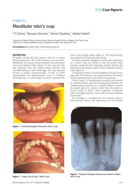 Pdf Mandibular Talons Cusp