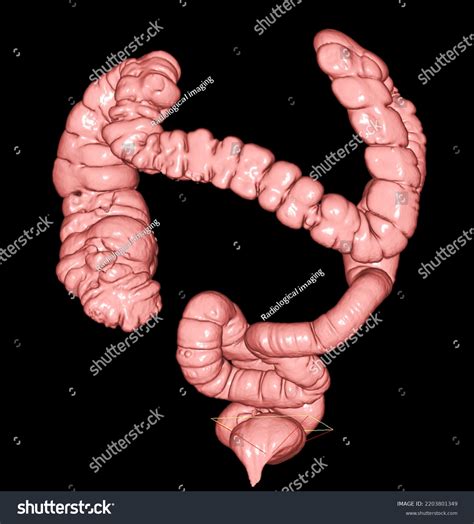 Ct Colonography Ct Colonography 3d Rendering Stock Illustration