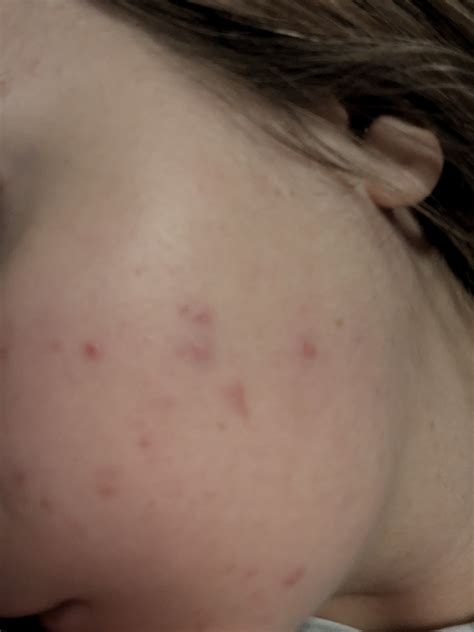 Высыпания на лице В последнее время часто стало высыпать правую щеку лоб Medaboutme