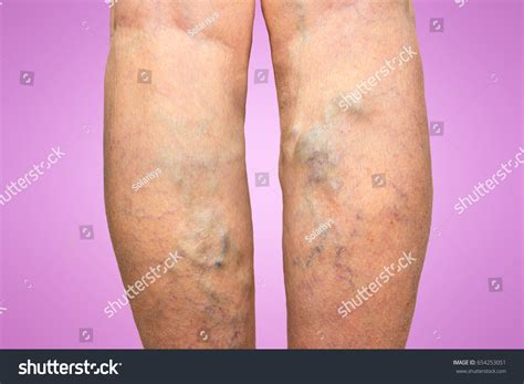 Varicose Veins On Female Legs Stock Photo Shutterstock