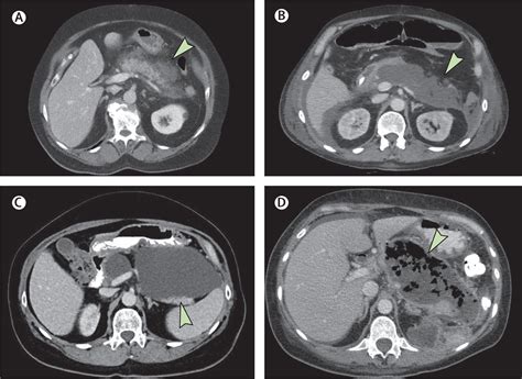 Acute Pancreatitis The Lancet