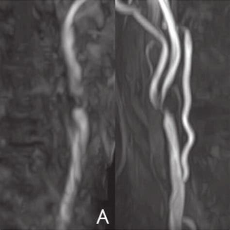 Right Common Carotid Angiogram Shows Internal Carotid Artery Stenosis