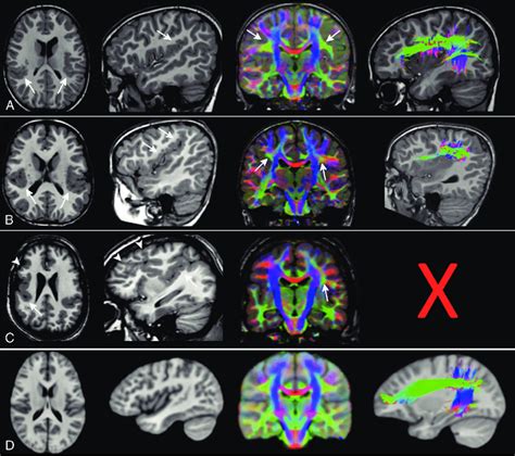 Superior Longitudinal Fasciculus