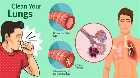 Home Remedies Break Up Mucus Chest At Barbara Eley Blog