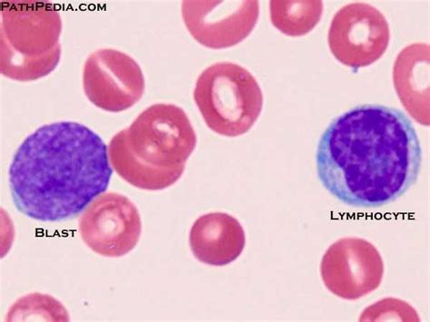 Blast Cells Hematology Medical Laboratory Science Medical Marketing