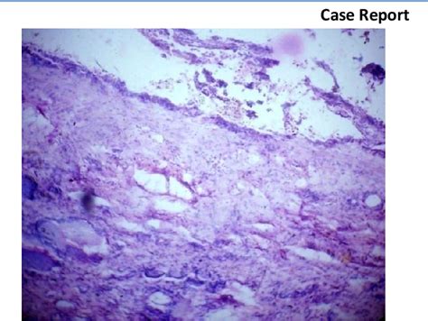 Figure 1 From Calcified Mesenteric Cyst An Unusual Presentation As