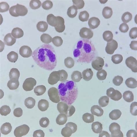 Toxic Granulation On Cbc