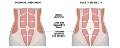 Abdominal Separation Or Diastasis Recti Dram In Pregnancy Move
